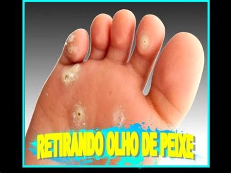 Retirando Olho De Peixe Removing Fish Eye Youtube