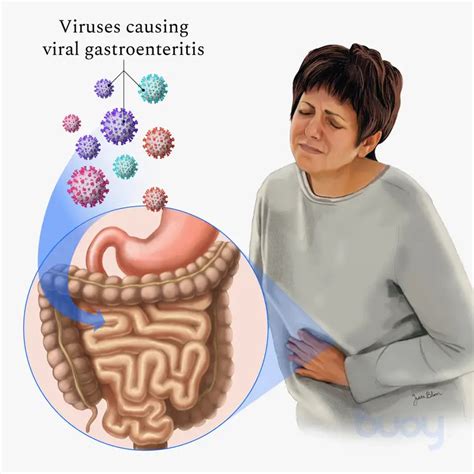 What Is Stomach Flu Viral Gastroenteritis Turkey Istanbul Medical