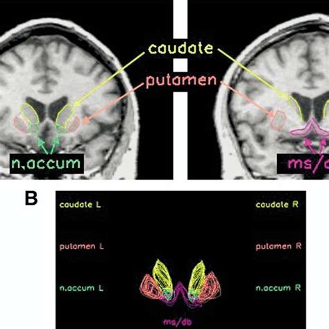 A Example Of Manual Outlining Of Caudate Putamen Nucleus Accumbens