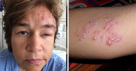 Herpes Z Ster Conhe A Os Tratamentos E Sintomas Do Cobreiro