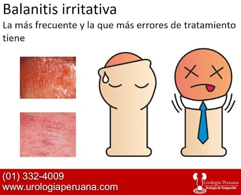 Urología Peruana Dr Susaníbar La balanitis mas frecuente es por una