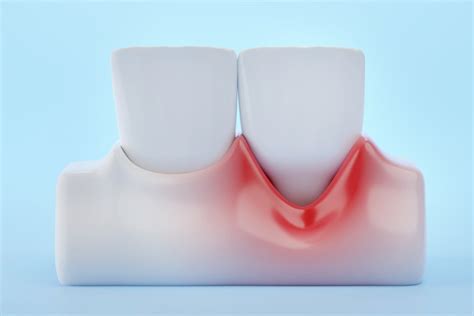 3 questions sur la récession gingivale comprendre identifier