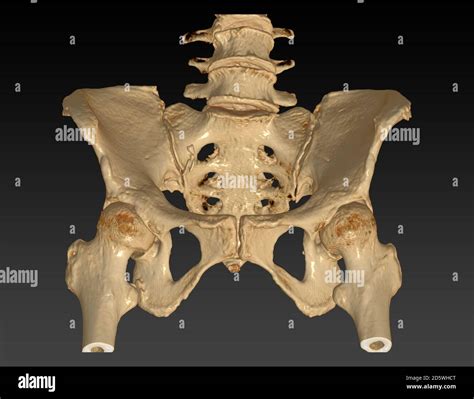 Pelvic Ct Scan