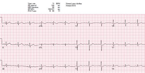 Posterior Myocardial Infarction Ecg