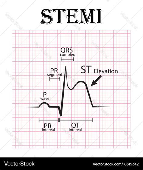 Ecg Of St Elevation Myocardial Infarction Stemi Vector Image