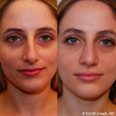 Crooked Nose Before And After