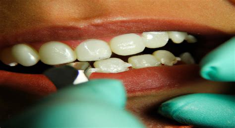 Qué es una endodoncia y qué tipos hay Fundacion Ecos