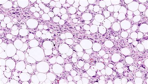 Pathology Outlines Myxoid Pleomorphic Liposarcoma