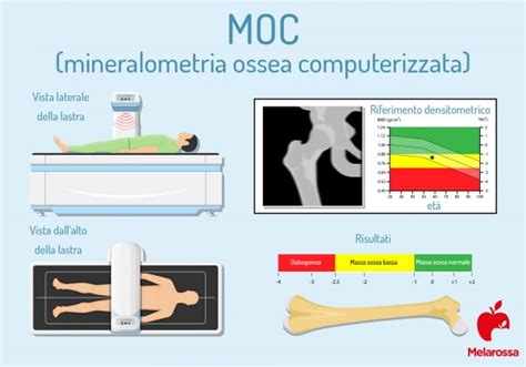 Osteoporosi cos è sintomi cura e prevenzione Melarossa