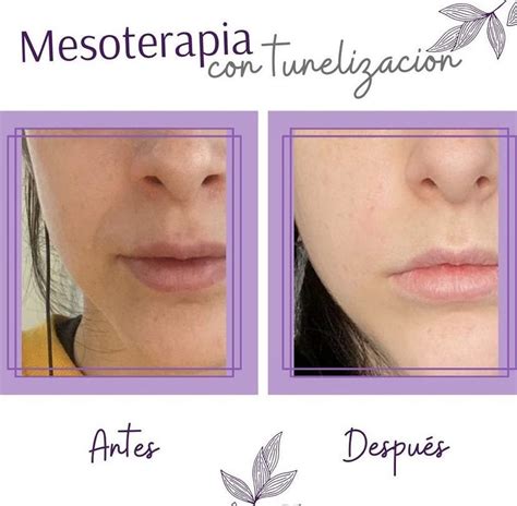 Mesoterapia Antes y después Esteticas ar Esteticas ar
