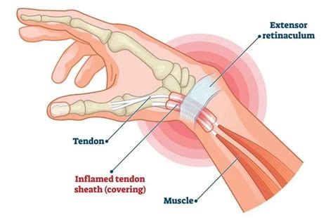 De Quervain S Tenosynovitis Costa Health Chiropractor