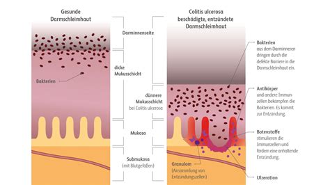 Colitis Ulcerosa Therapie Symptome Ursachen BMS Immunologie
