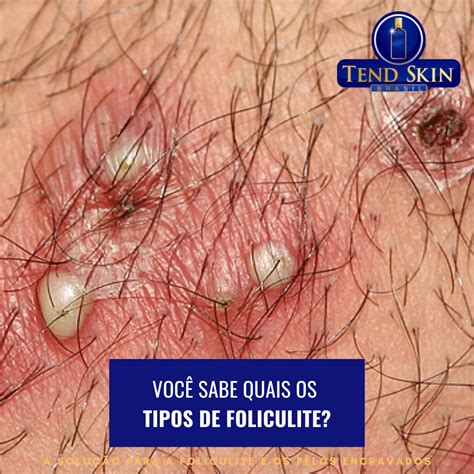 Você sabe quais os tipos de foliculite
