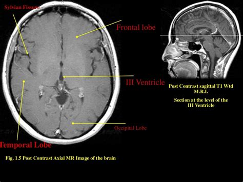 MRI SECTIONAL ANATOMY OF BRAIN