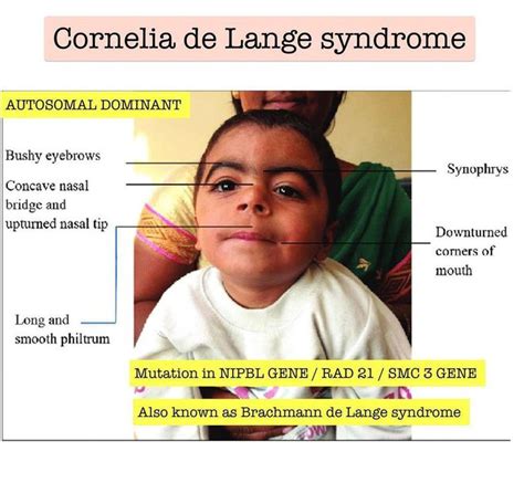 Cornelia De Lange Syndrome MEDizzy