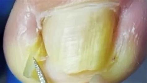 The Whole Process Of Trimming Ingrown Nails Relieves Pain Magicknife