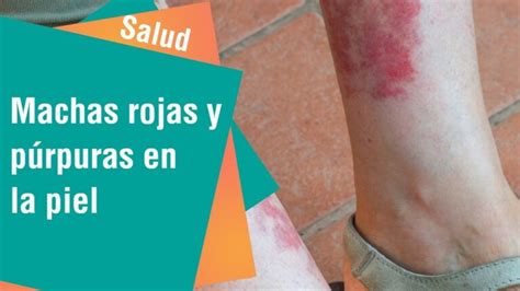 Manchas rojas en las piernas sin picor ni dolor qué significan