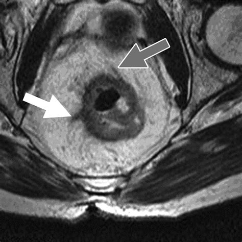 MRI For Detection Of Extramural Vascular Invasion In Rectal Cancer AJR