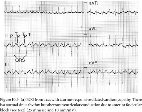 Figure 10 1 From Intraventricular Conduction Defects Semantic Scholar