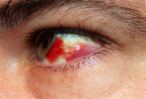 Subconjunctival Hemorrhage Medlibes Online Medical Library