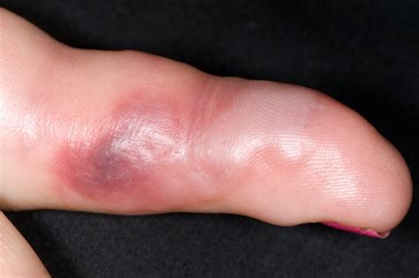 Insect Bites And Stings Nhs