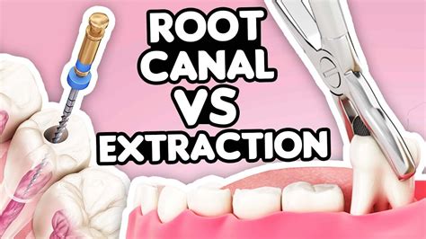 Root Canal Vs Tooth Extraction Whats The Right Choice YouTube