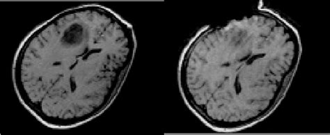 figure 1 from nonrigid registration of medical images using finite element modeling semantic