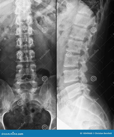 Radiograf A De La Espina Dorsal Lumbar Con Skoliosis S Shaped Leve Foto