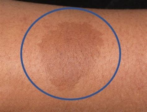 Do Not Be Rash With Rashes A Guide To Dermatological Description