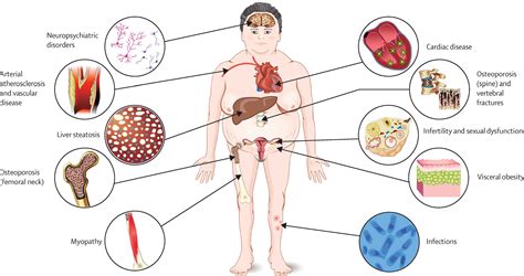 Complications Of Cushing S Syndrome State Of The Art The Lancet