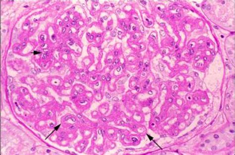 Glomerular Disease III Flashcards Quizlet