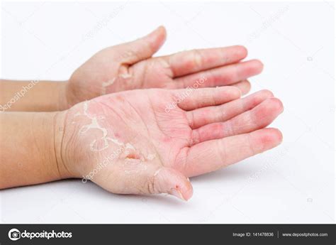 Dry Hands Peel Contact Dermatitis Fungal Infections Skin Infections