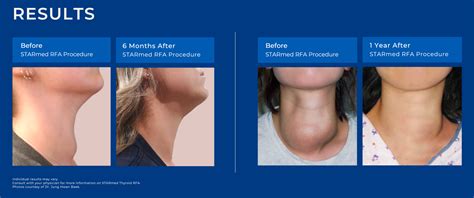 RFA For Thyroid Nodules Portland Diabetes Endocrinology Center