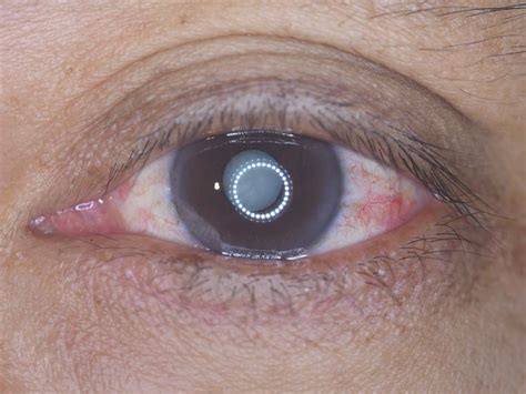 Facosclerosi o sclerosi del cristallino che cos è Área Oftalmológica