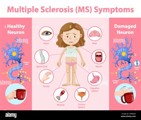 Multiple Sclerosis Ms Symptoms Information Infographic Stock Vector