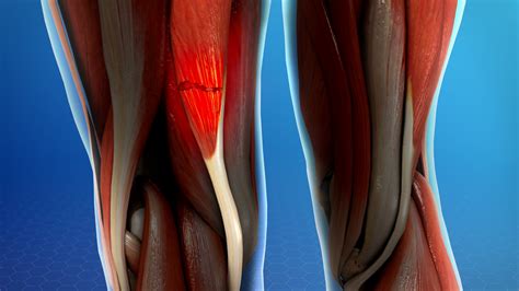 Que Es Lesion Muscular