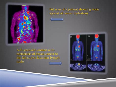 Positron Emissions Tomography PET SCAN PPT