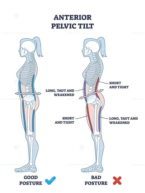 Anterior Pelvic Tilt Or APT As Pelvis Abnormal Posture Outline Diagram