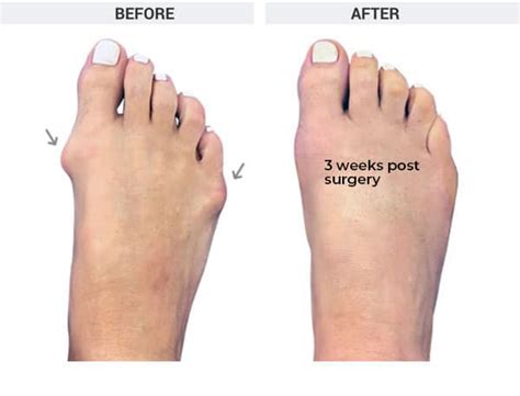 Minimally Invasive Bunion Surgery Bunionplasty The Bunion Institute