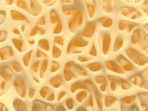 Osteoporose O Que é Causas Sintomas E Tratamentos Blog Da Saúde