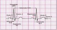 Cómo interpretar un electrocardiograma Paso a paso