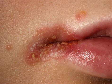 Infectious Cheilitis
