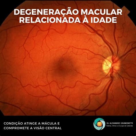 Degeneracao Macular Relacionada A Idade Dr Alexandre Grandinetti