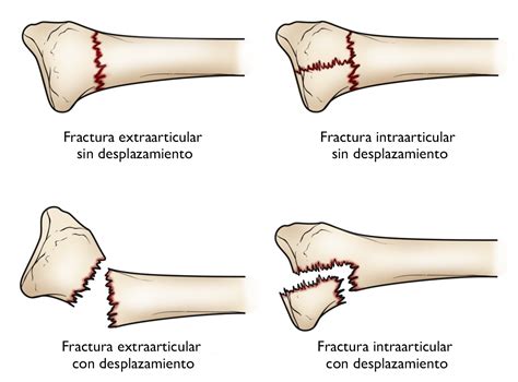 Fracturas distales del radio muñeca quebrada Distal Radius Fractures