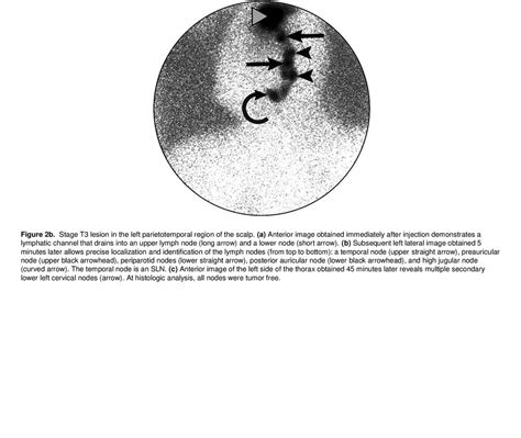 Figure B Stage T Lesion In The Left Parietotemporal Region Of The