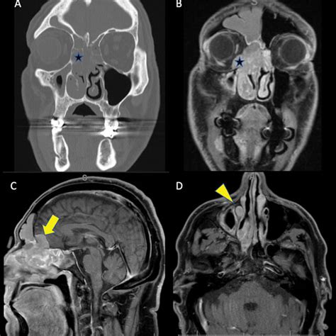 Preoperative Computed Tomography CT And Magnetic Resonance