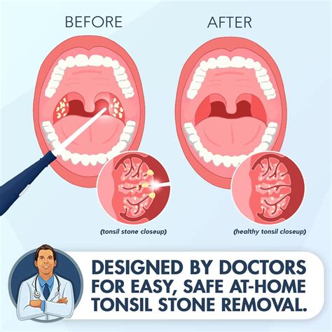 Dr Frederick S Easy Tonsil Stone Remover Kit Fast Painless