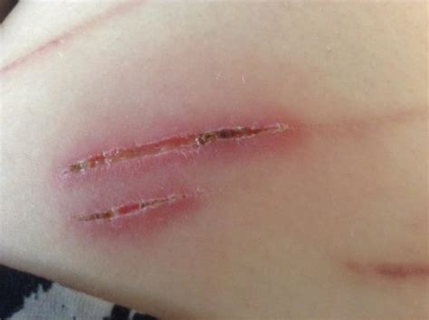 Is My Cut Infected Or Just Healing