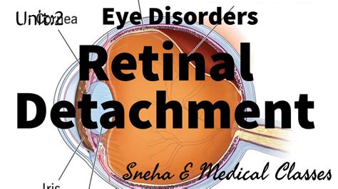 Retinal Detachment Cause Sign Symptoms Pathophysiology