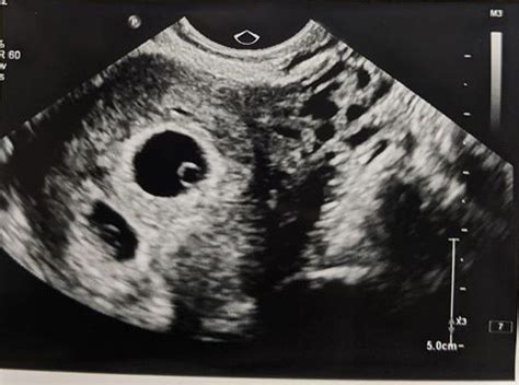 Weeks Pregnant With Twins Twiniversity
